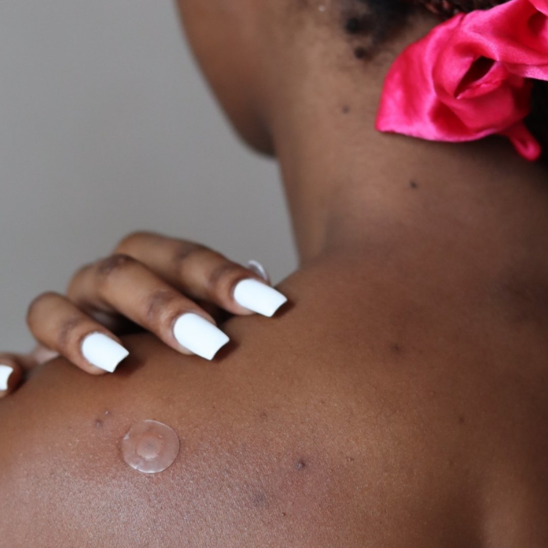 Battling Backne: Causes, Treatments, and Tips for Clear Skin – The ...